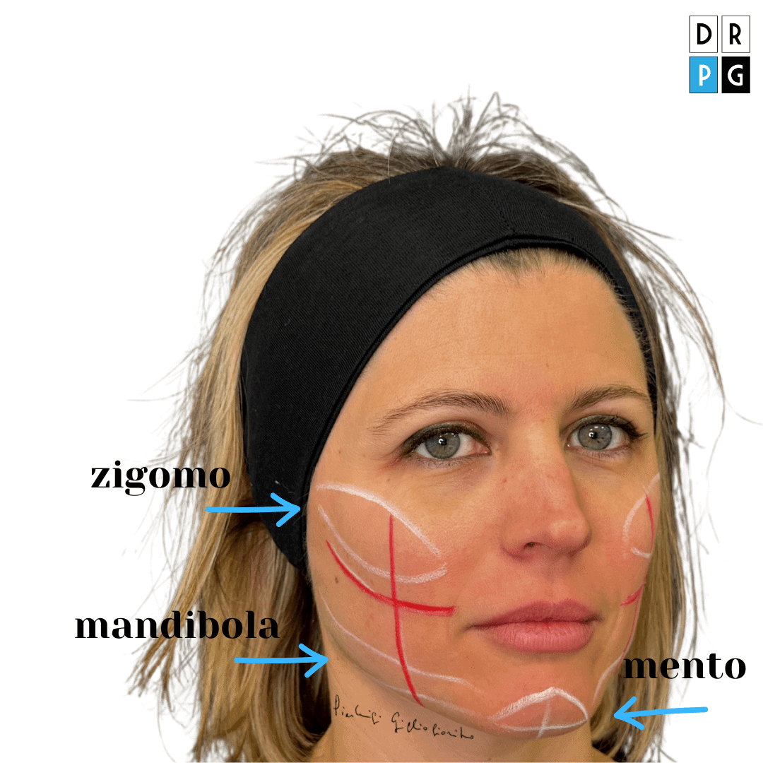 Full Face Contouring: zigomi, mento, mandibola | Dr. Gigliofiorito